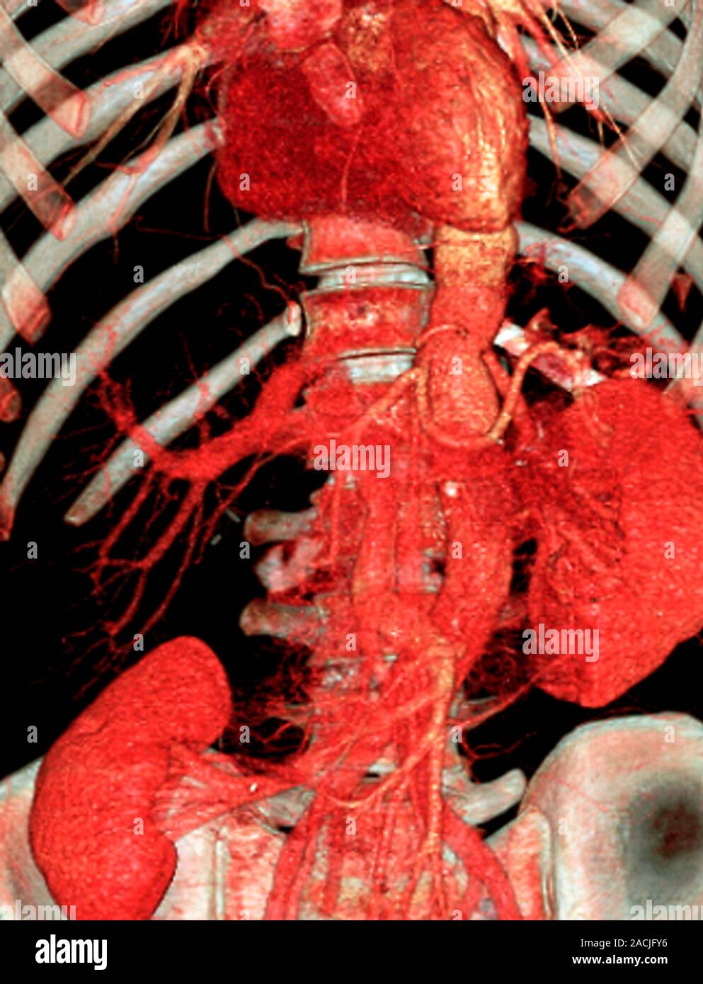 Coloured three-dimensional (3D) computed tomography (CT) angiography scan (front view) of the ...