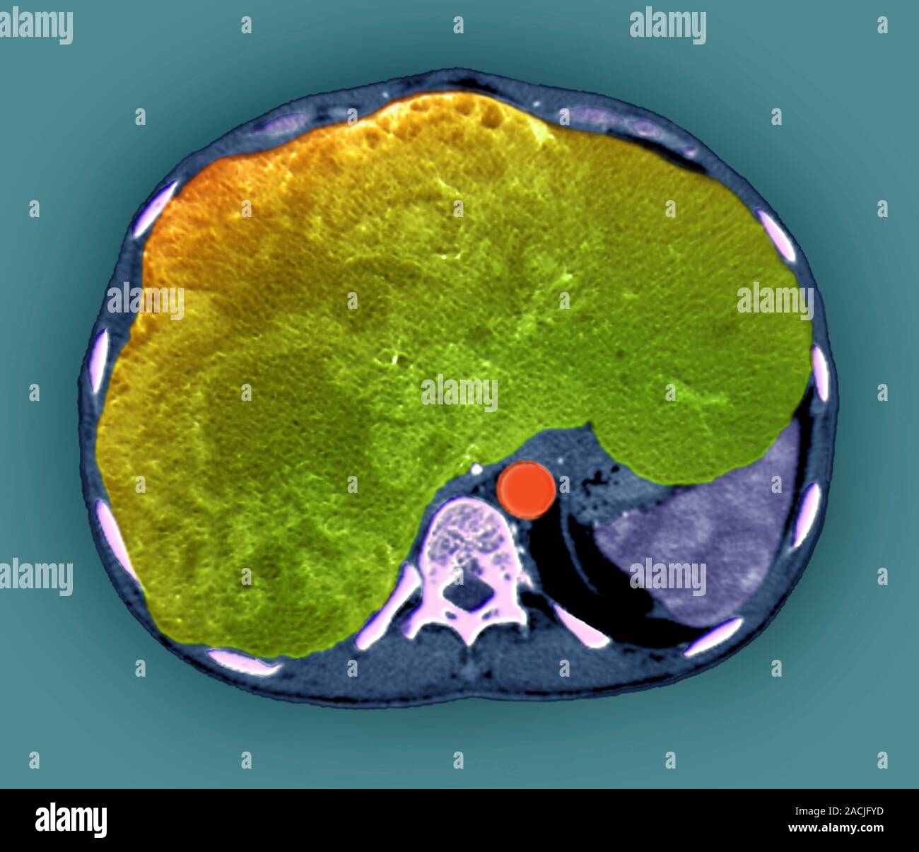 Coloured computed tomography (CT) scan in axial section of the abdomen in a 54 year old patient ...
