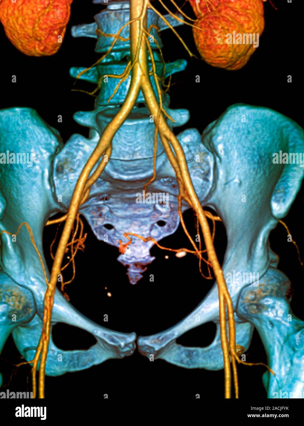 Coloured three-dimensional (3D) computed tomography (CT) angiography scan in front view of ...