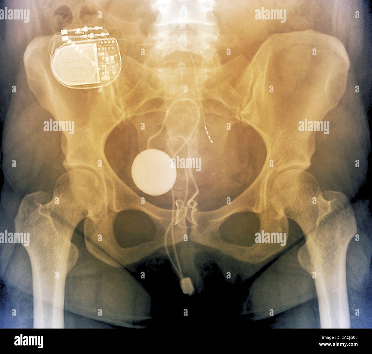 Coloured X-ray (front view) of the pelvis in a 28 year old disabled ...
