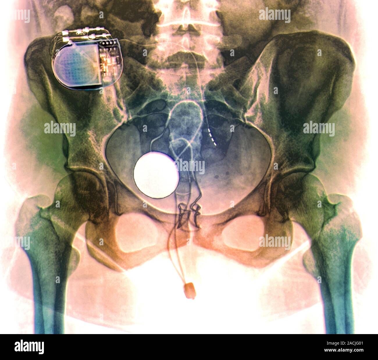 Coloured X-ray (front view) of the pelvis in a 28 year old disabled ...
