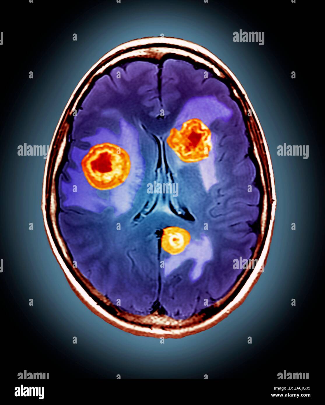 Coloured magnetic resonance imaging (MRI) scan in axial section through the brain of a 47 year ...