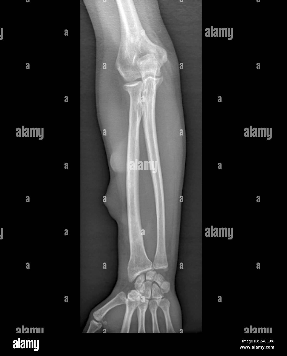 X-ray of the forearm in a 53 year old patient showing a lipoma, a ...