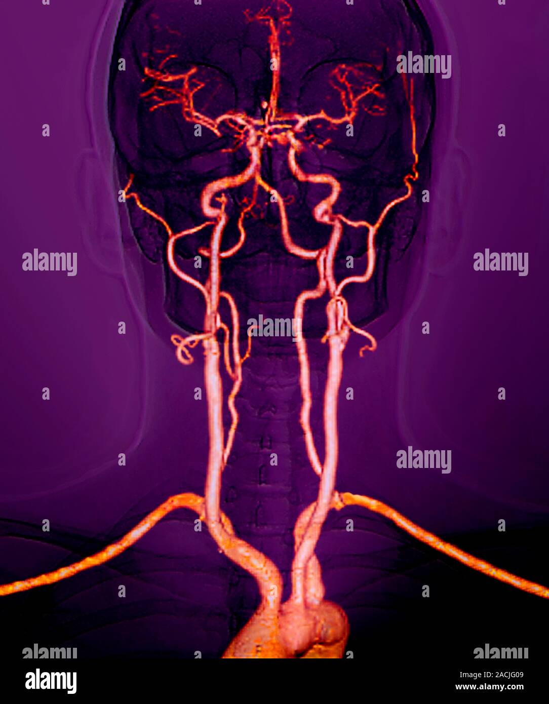 Coloured three-dimensional (3D) computed tomography (CT) angiography scan in front view of the ...