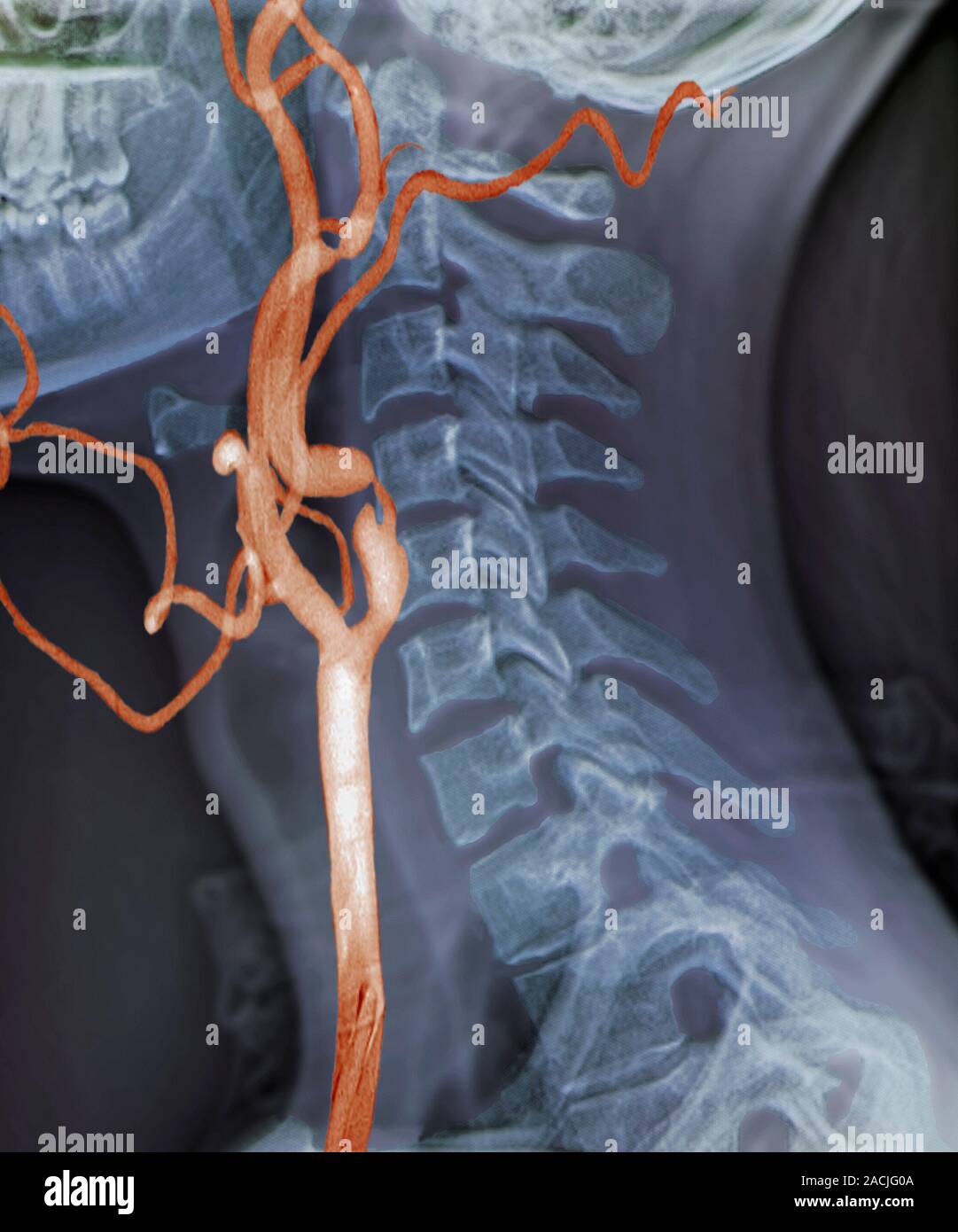 Coloured three-dimensional (3D) computed tomography (CT) angiography scan in side view of the ...