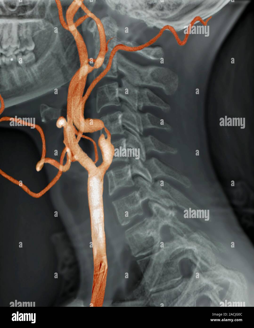 Coloured three-dimensional (3D) computed tomography (CT) angiography ...