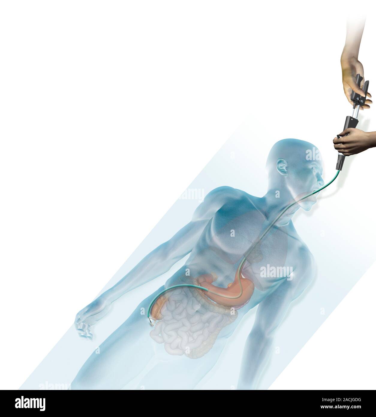 Laparoscopic appendicectomy. Computer artwork showing a person's ...