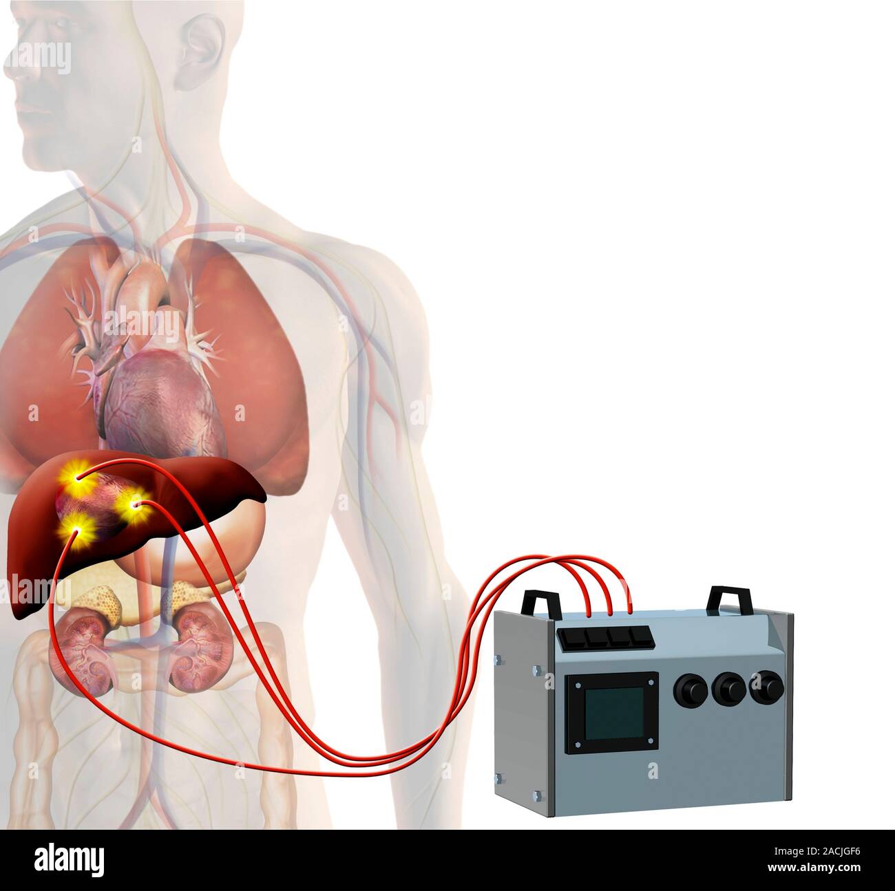 Treating cancer with lasers. Computer artwork showing lasers focused on ...