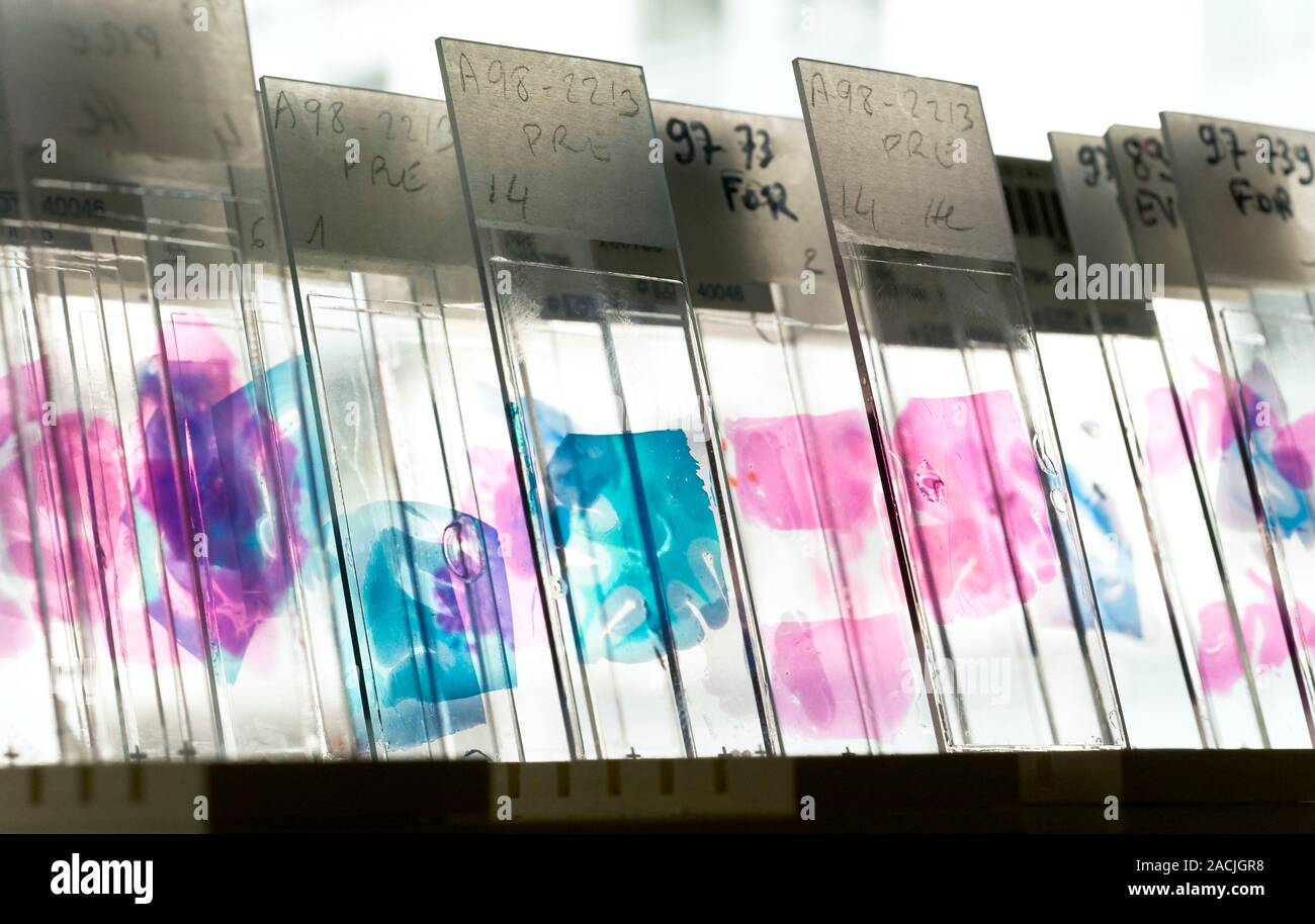 Neuropathology lab. Slides prepared with samples of brain tissue ...