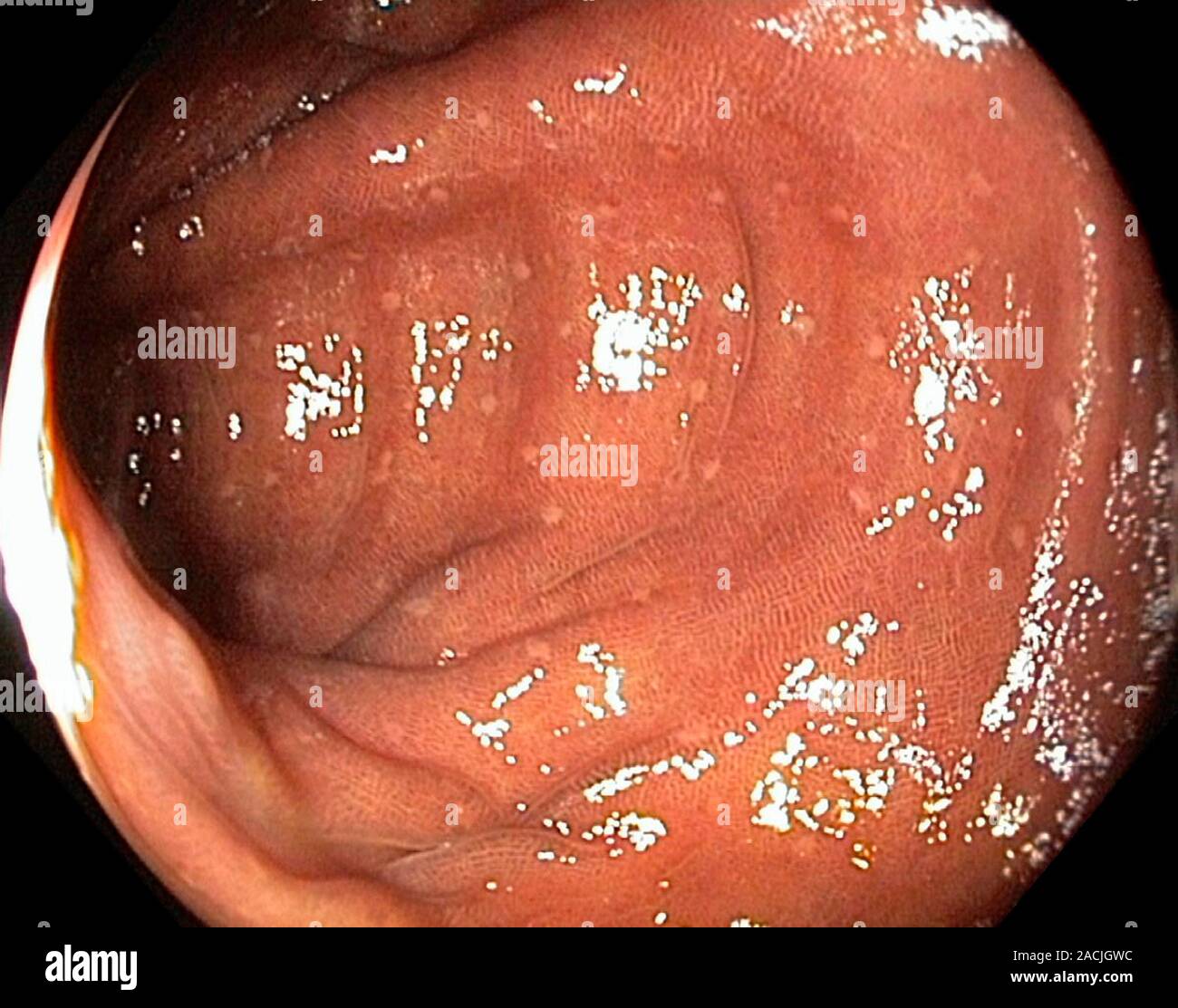 Endoscope view of a darkened pigmentation (melanosis) of the colonic ... Endoscope view of a darkened pigmentation (melanosis) of the colonic ...