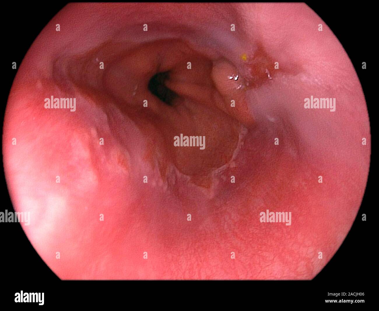 Endoscope view of the lower part of the oesophagus showing oesophagitis ...
