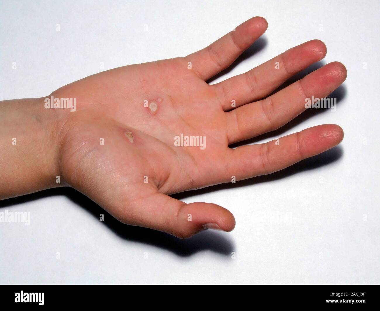 Electric burns. Lesions on the hand of a 15-year-old girl who was ...