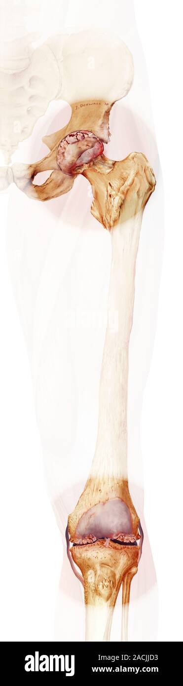 Bone death. Computer artwork of a human hip and knee joint affected by ...