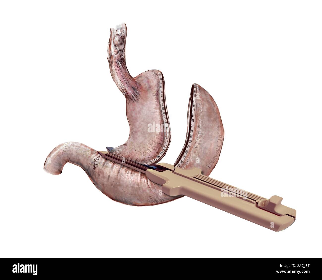 Gastric tube reconstruction. Computer artwork showing a gastric tube ...