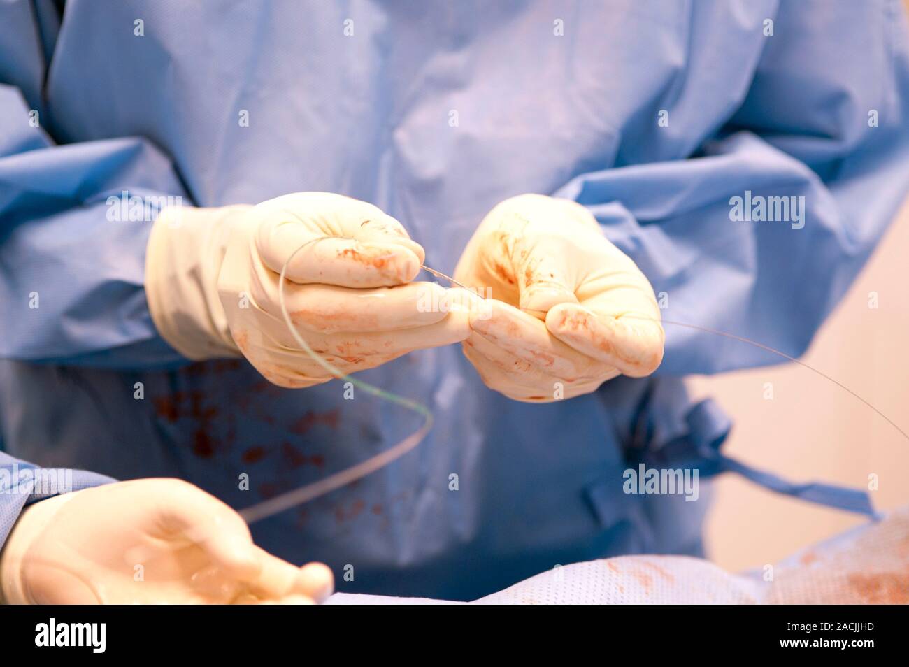 Coronary angioplasty surgery. Surgeon performing an angioplasty on a ...
