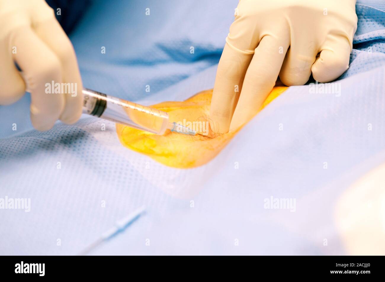 Coronary angioplasty surgery. Surgeon injecting a patient with local ...