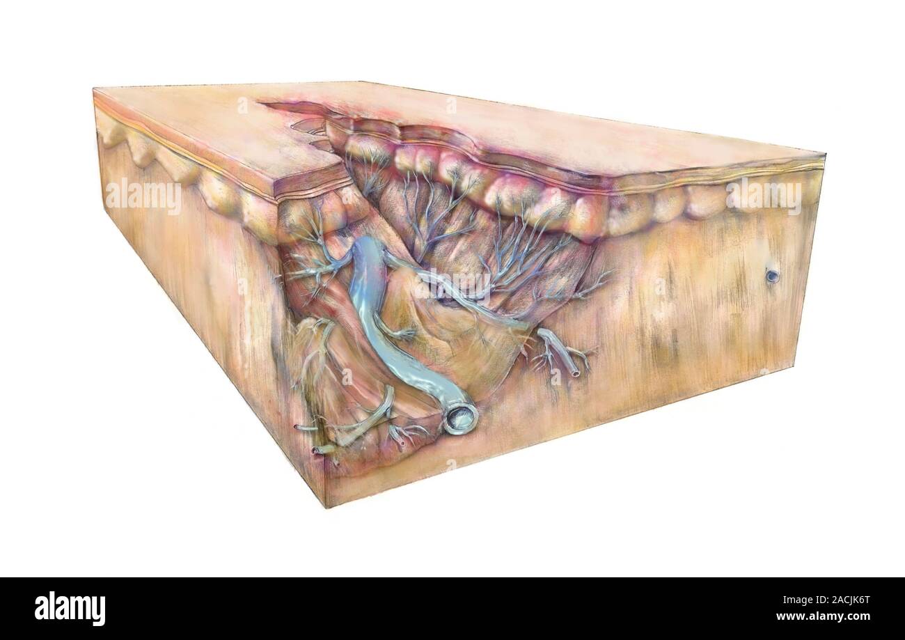 Wound healing. Artwork 2 of 4 showing wound healing. This is the ...