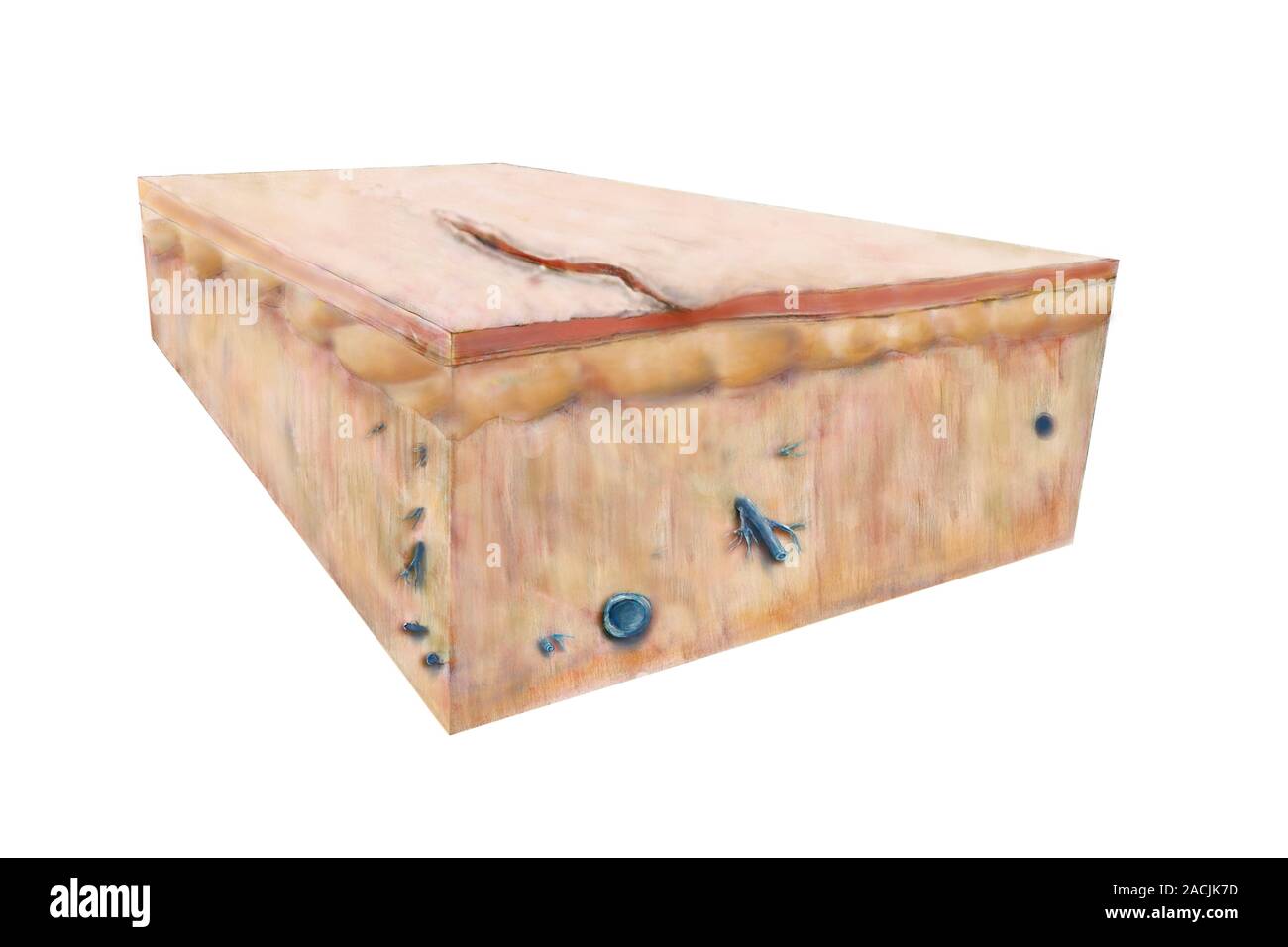 Wound healing. Artwork 4 of 4 showing wound healing.The wound is almost ...