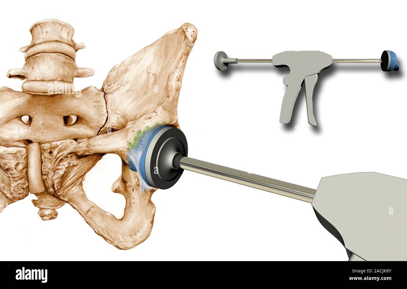 Hip replacement. Artwork showing bone cement (green) being injected ...