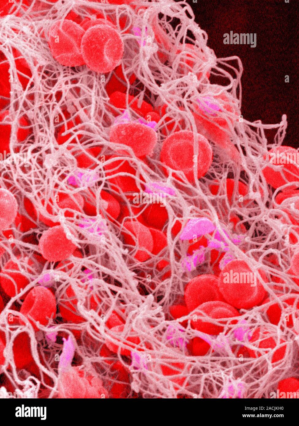 Blood clot, coloured scanning electron micrograph (SEM). Red blood ...