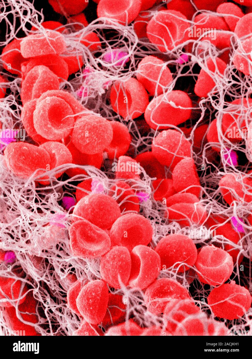 Blood clot, coloured scanning electron micrograph (SEM). Red blood ...