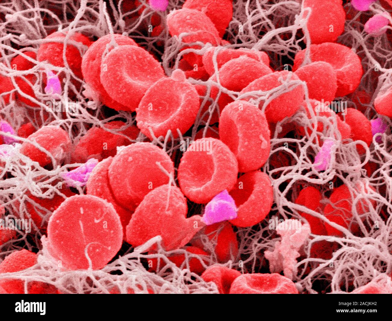 Blood clot, coloured scanning electron micrograph (SEM). Red blood ...