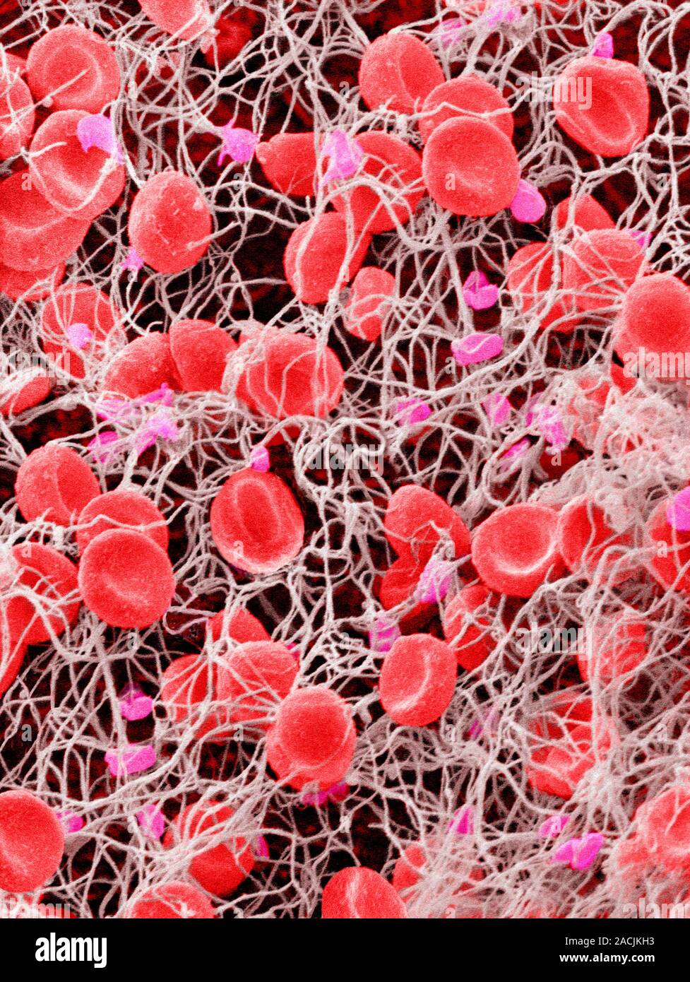 Blood clot, coloured scanning electron micrograph (SEM). Red blood ...