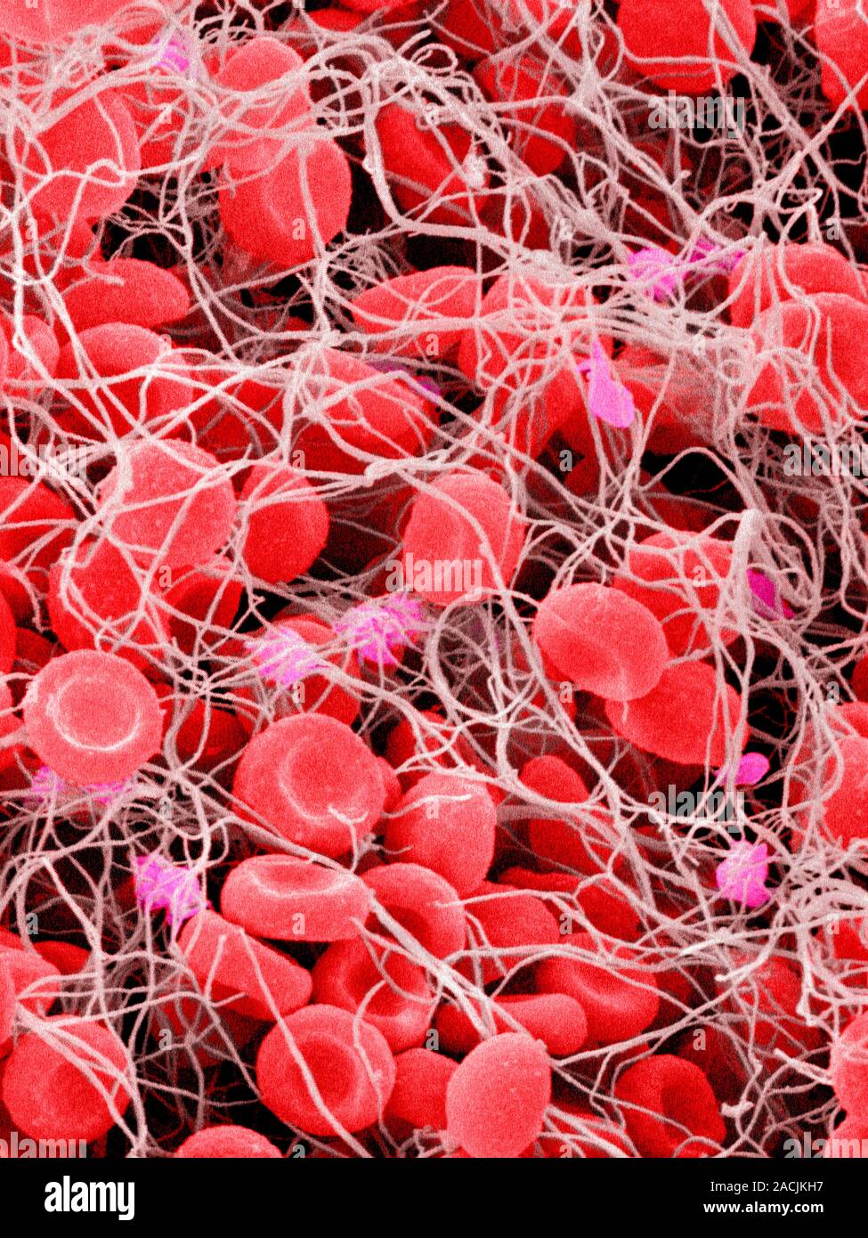 Blood clot, coloured scanning electron micrograph (SEM). Red blood ...