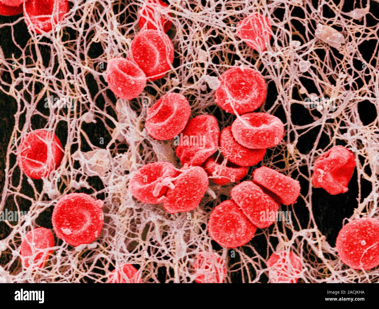 Blood clot, coloured scanning electron micrograph (SEM). Red blood ...