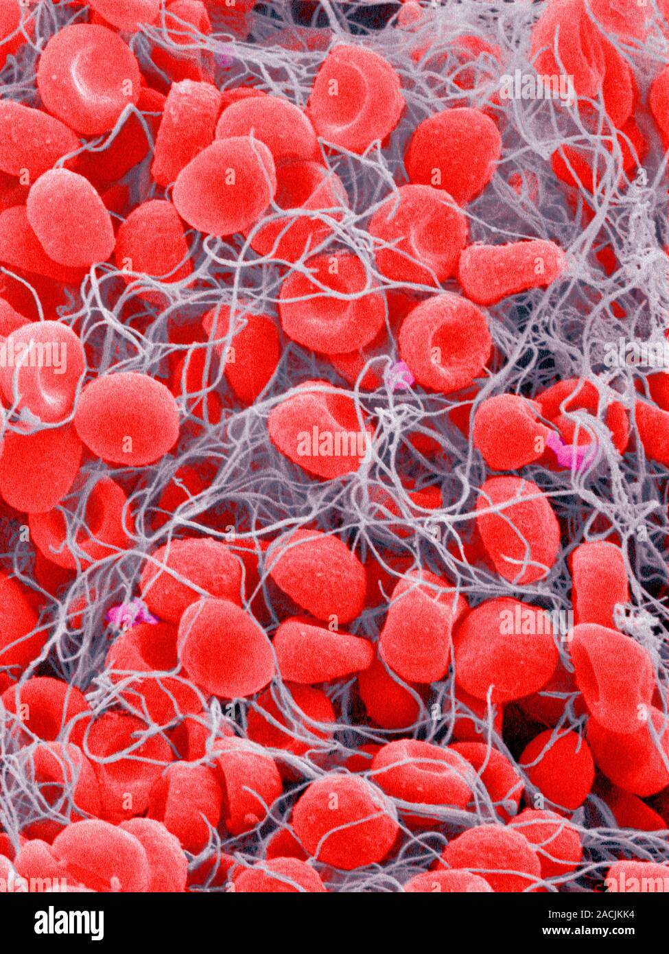 Blood clot, coloured scanning electron micrograph (SEM). Red blood ...