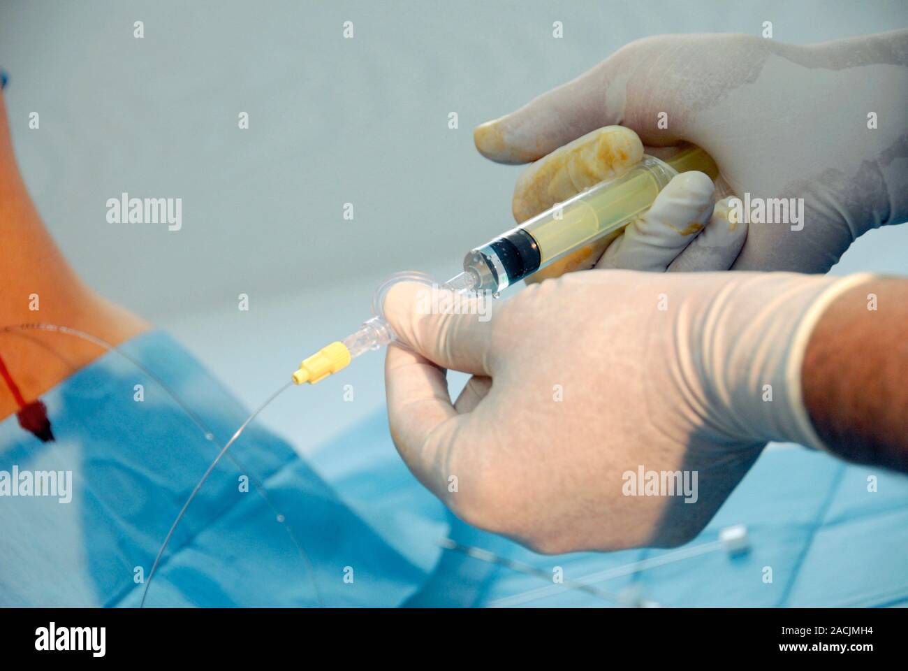 Gloved hands of an anaesthetist inject an epidural anaesthetic into a ...