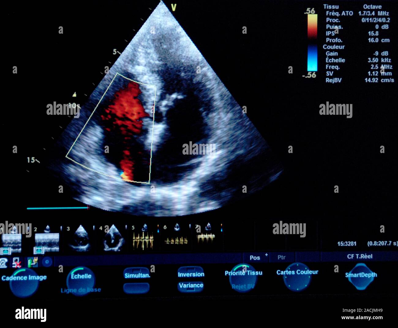 Doppler ultrasound (echocardiography) scan of the heart in adult male ... Doppler ultrasound (echocardiography) scan of the heart in adult male ...
