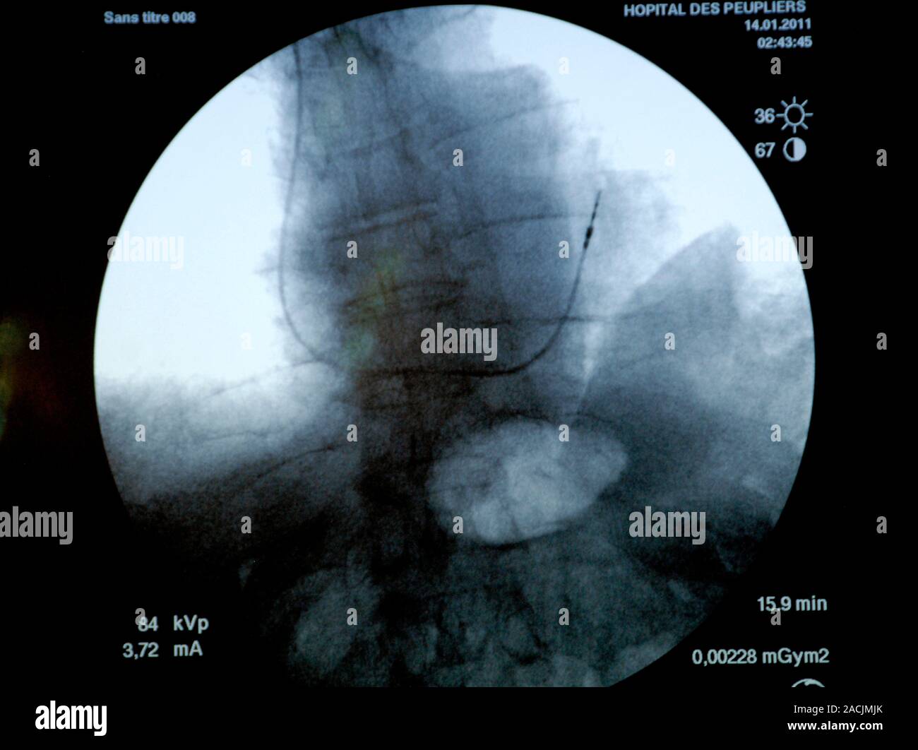 X-ray (front view) of the chest in a patient fitted with a heart ...