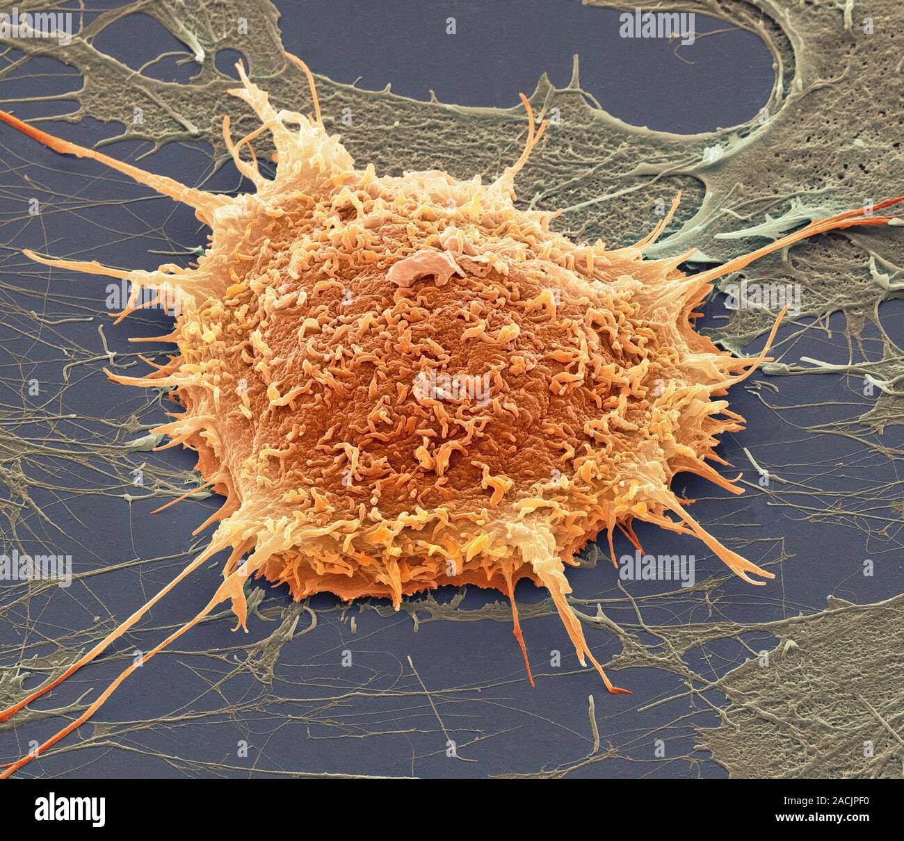 Cervical cancer cell, coloured scanning electron micrograph (SEM ...