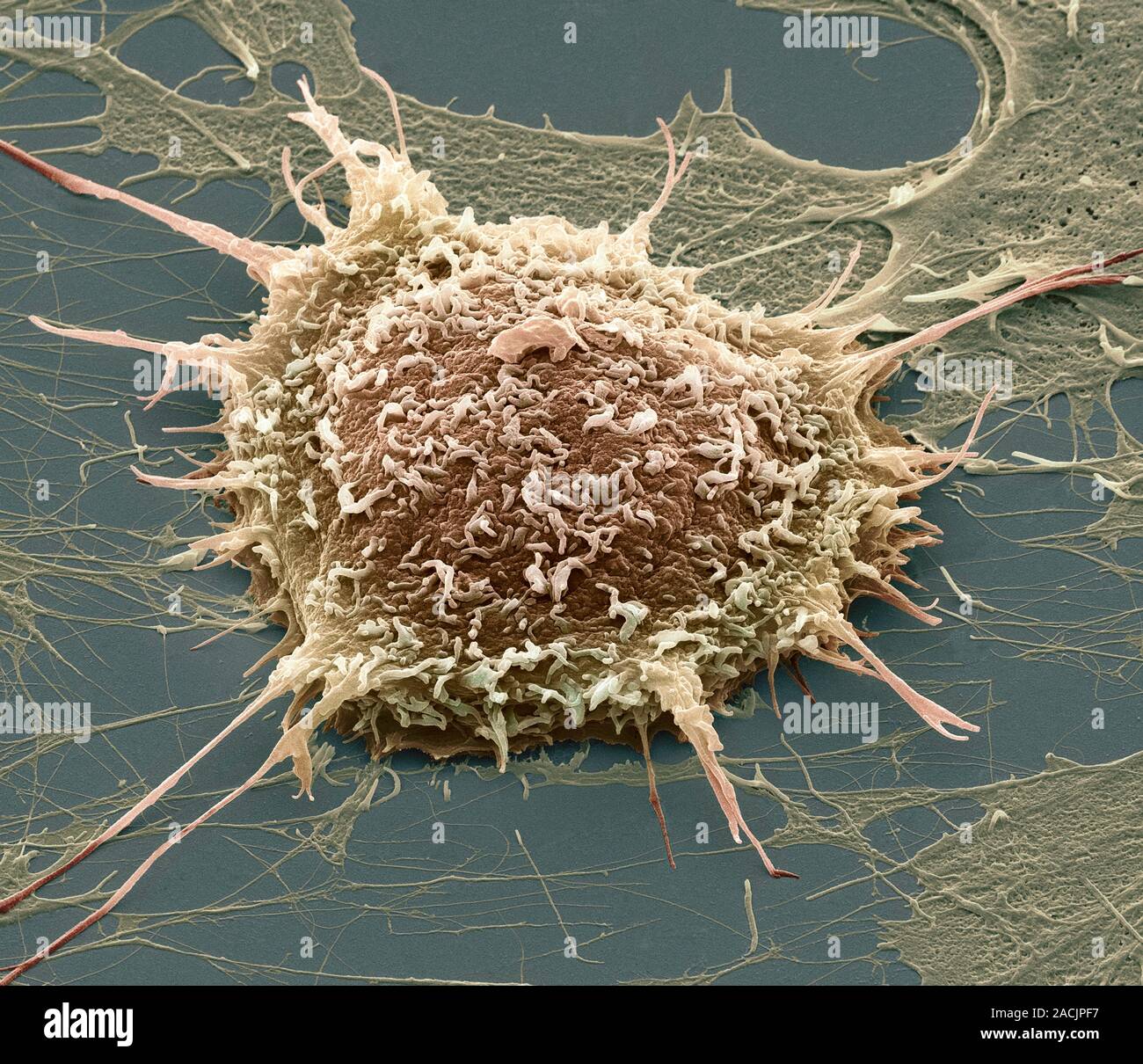 Cervical cancer cell, coloured scanning electron micrograph (SEM ...