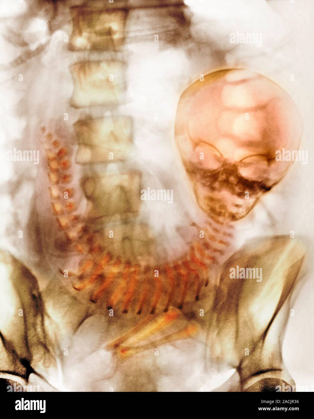 Full term foetus. Coloured X-ray of a full term (9-month-old) foetus in ...