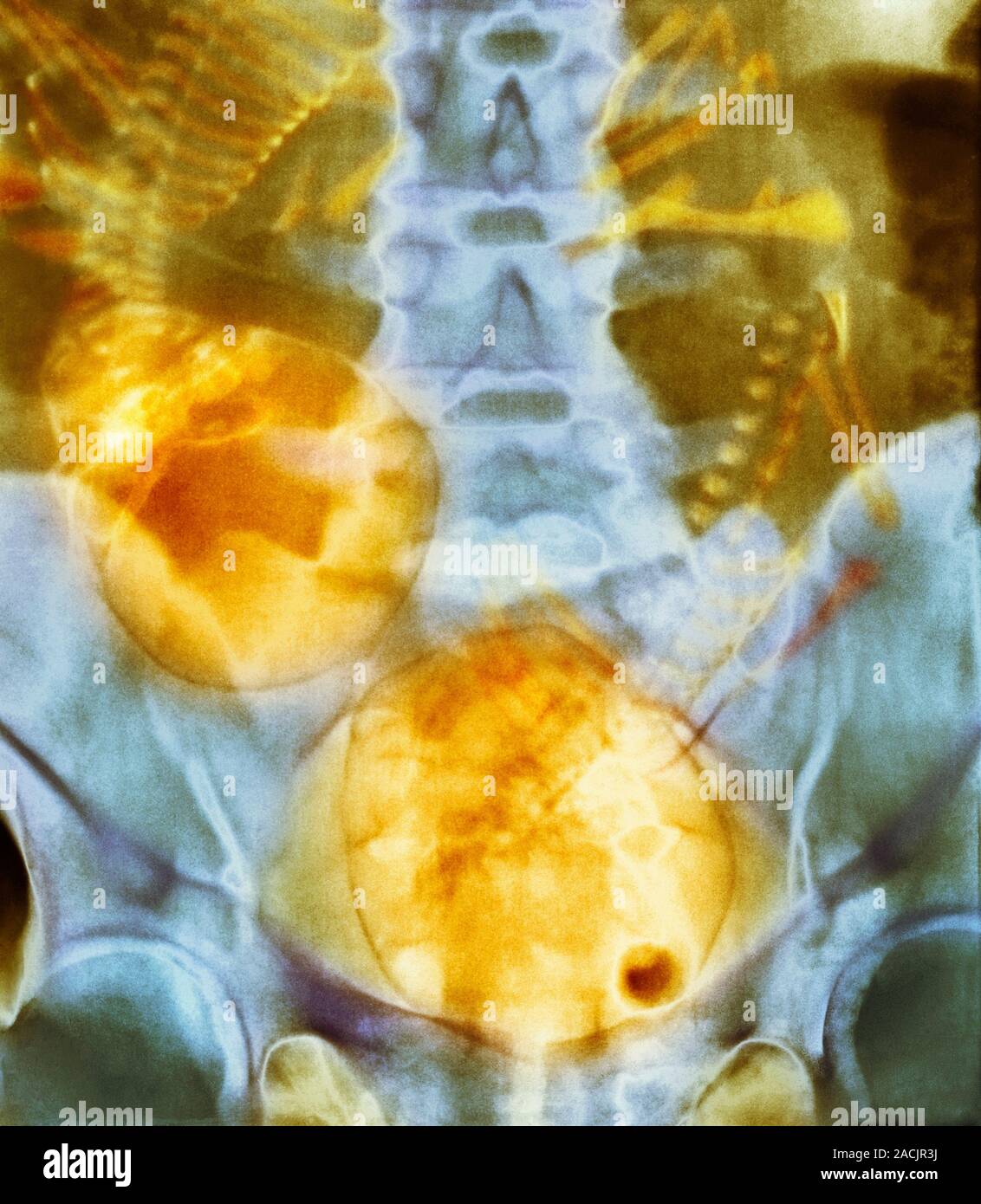 Full term foetus twins. Coloured X-ray of two full term (9-month-old ...