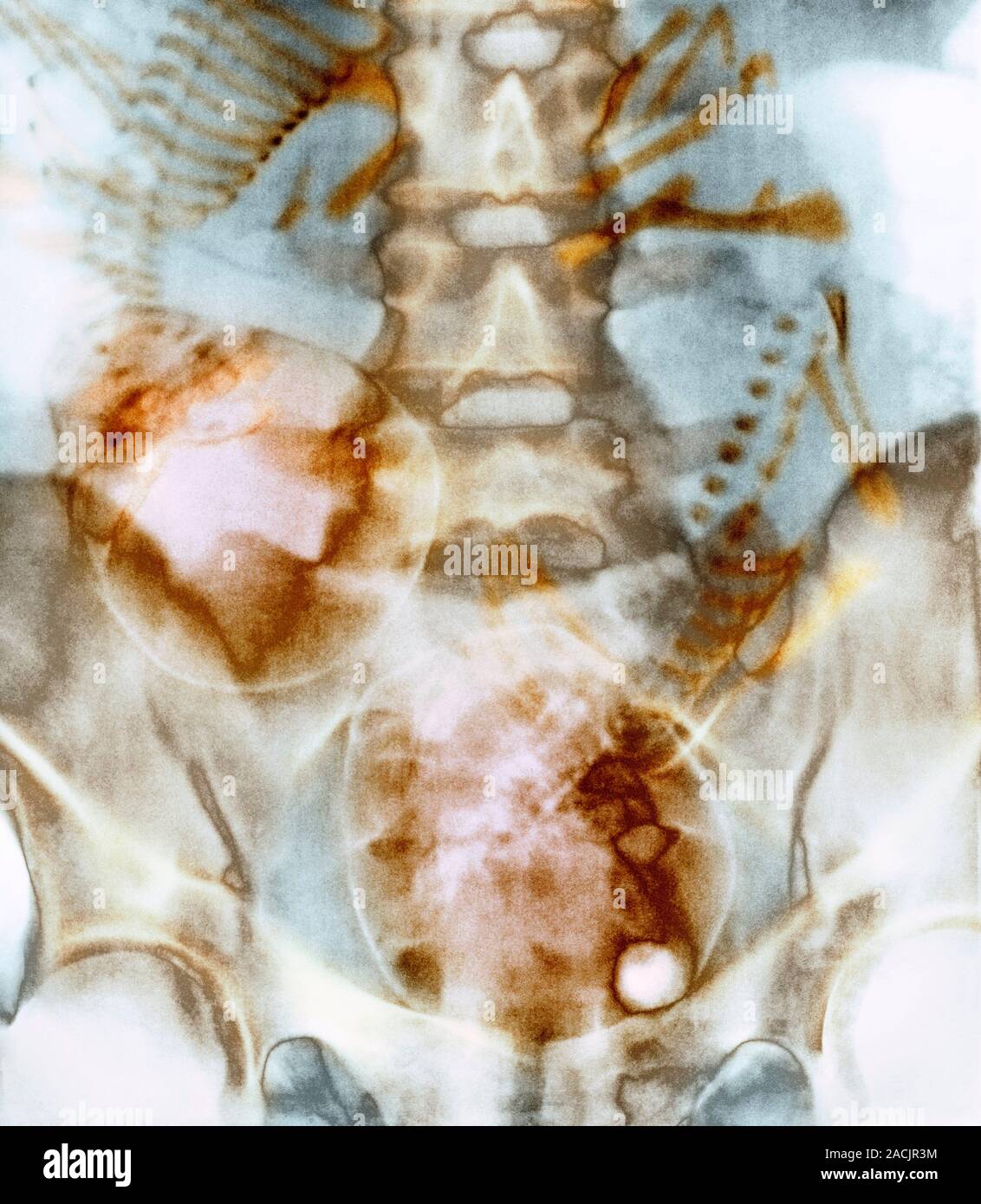 Full term foetus twins. Coloured X-ray of two full term (9-month-old ...