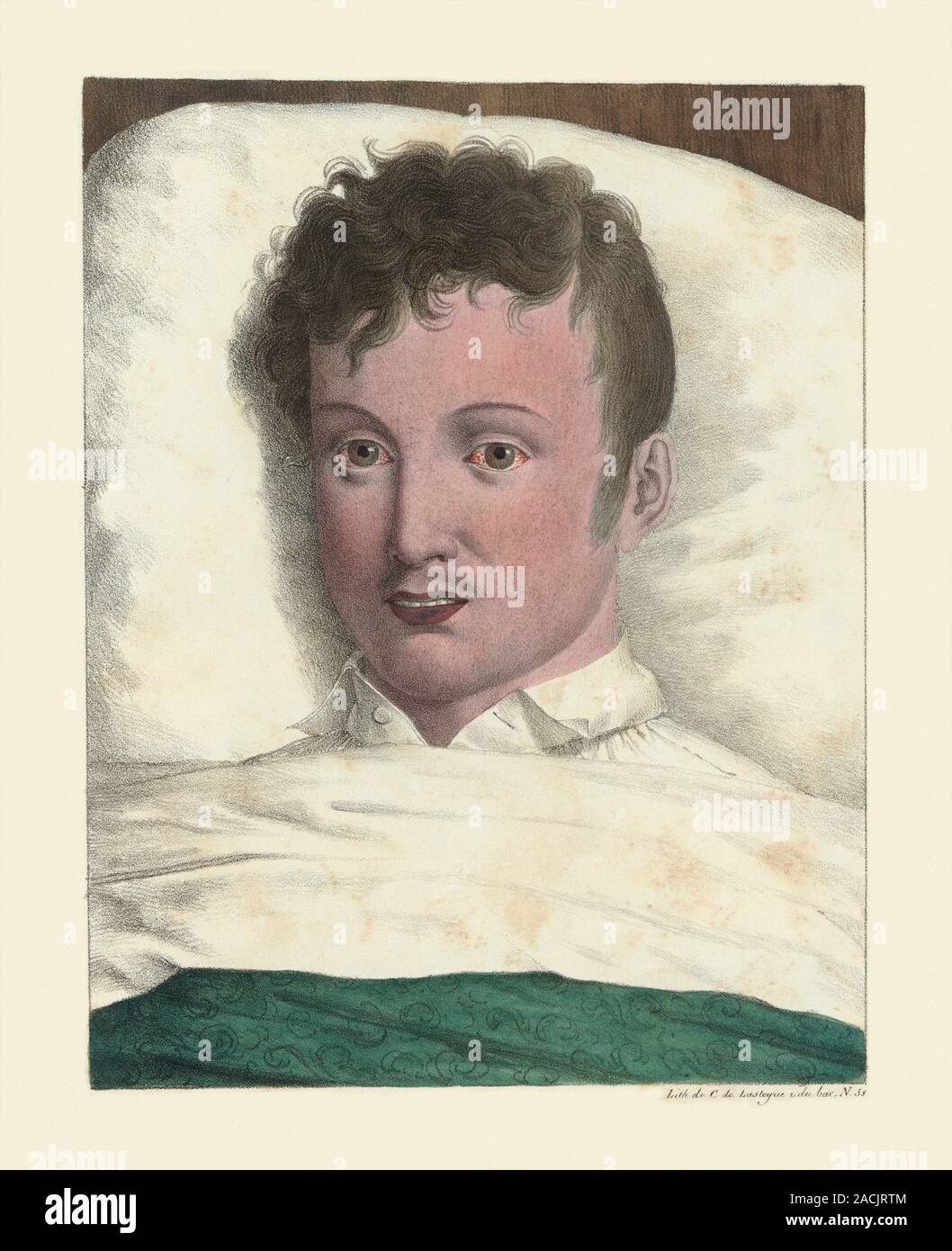 Yellow fever sequence. This portrait, the second in a sequence of four ...