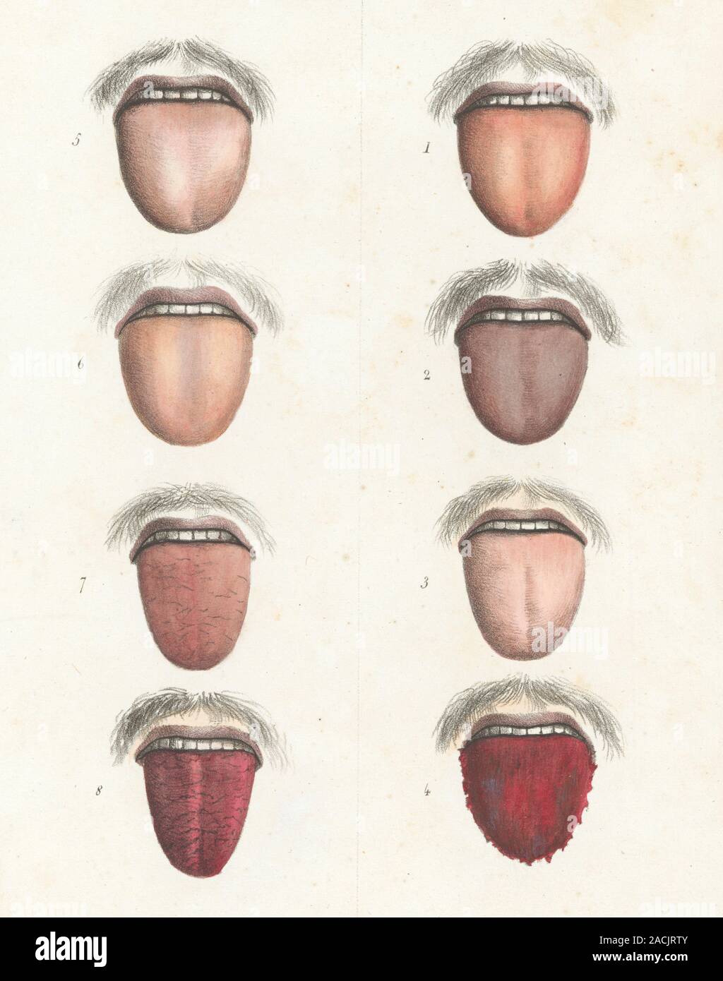 Yellow fever symptoms. Artworks of eight numbered artworks of the ...