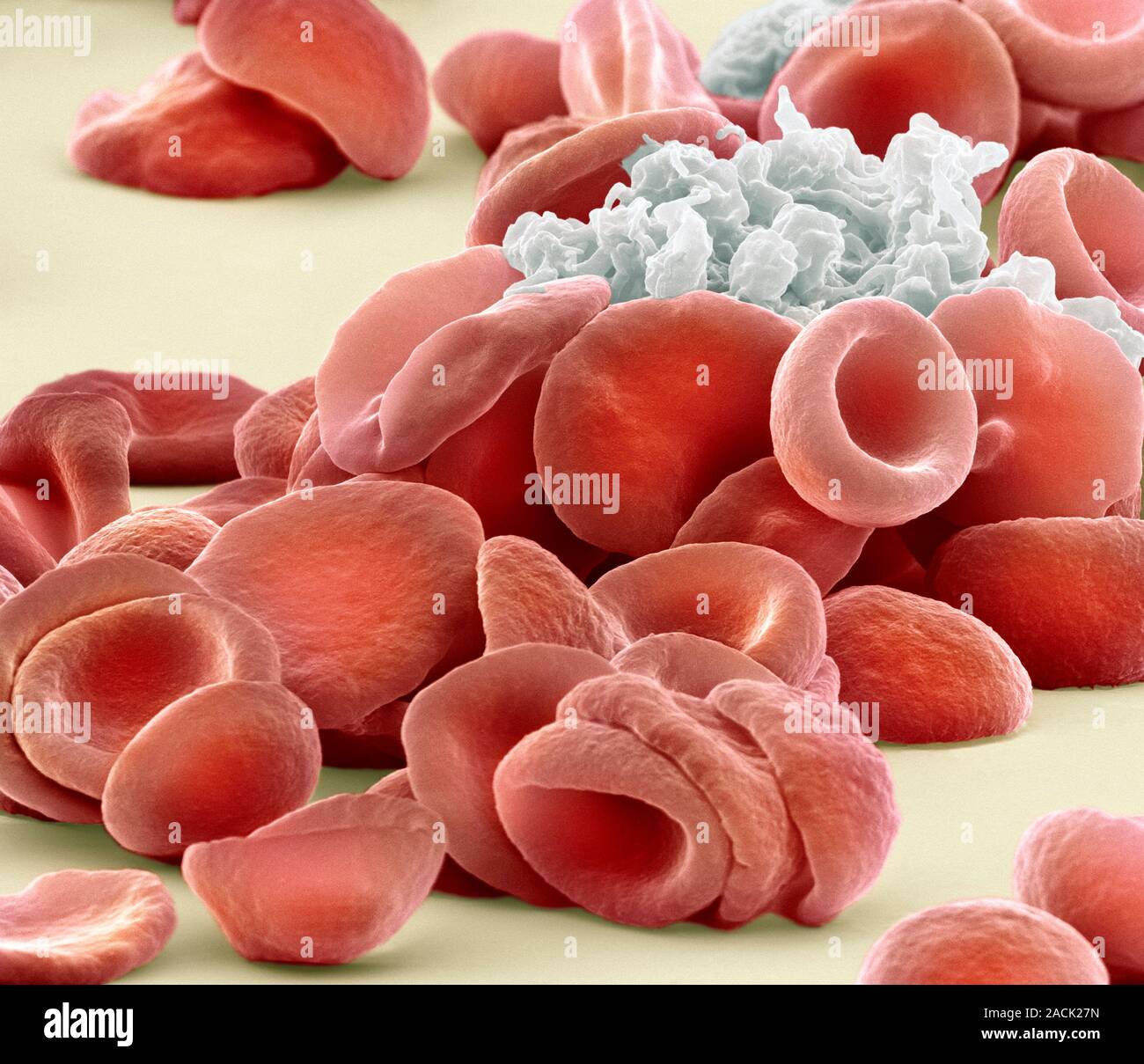 Blood clotting. Coloured scanning electron micrograph (SEM) of human ...