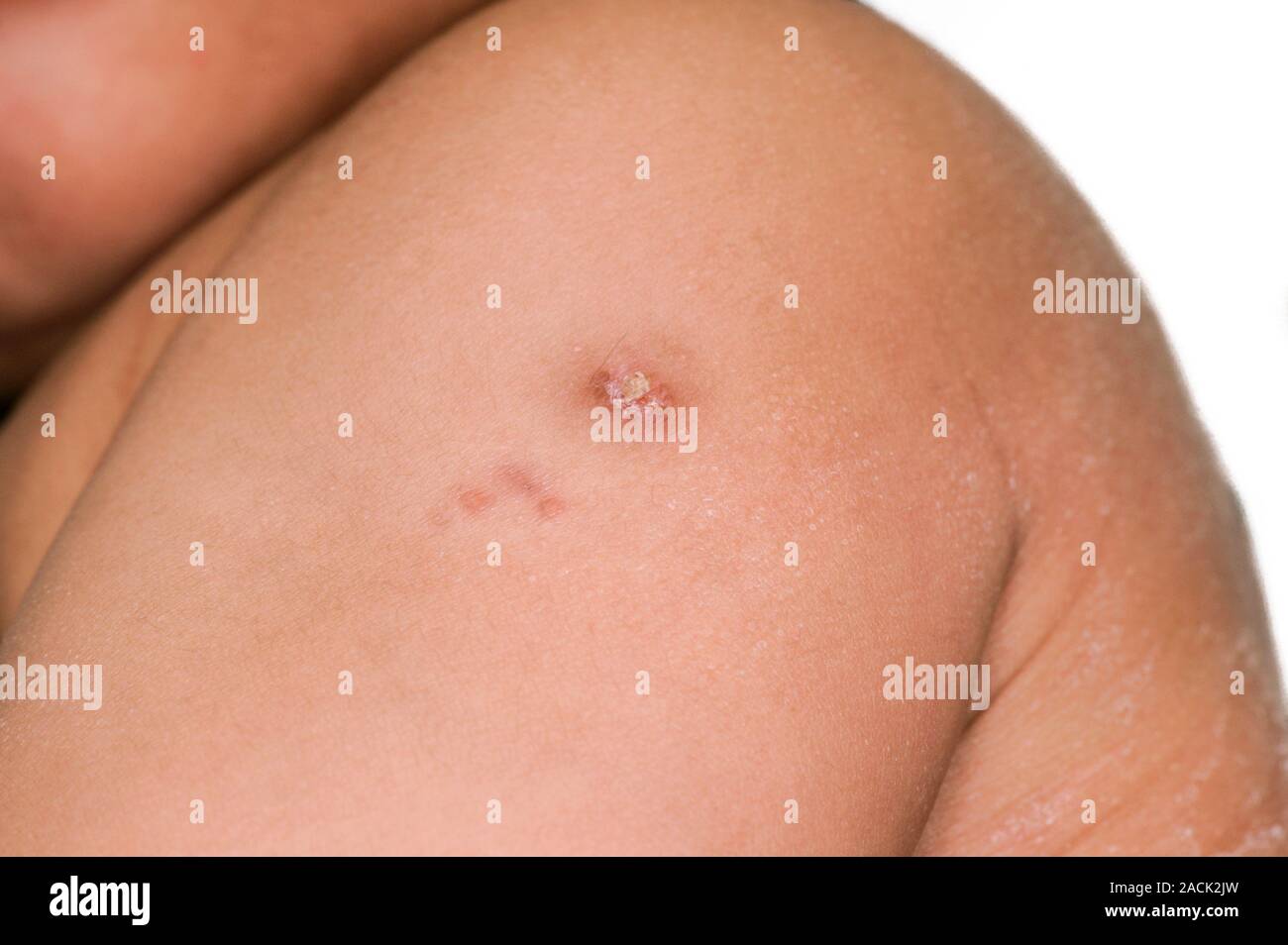 Not for use in Television Not for use in Television Scar on the upper ...