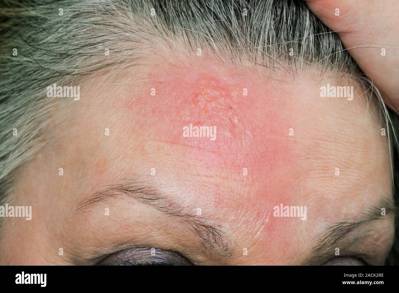 Not for use in Television Not for use in Television Shingles rash on ...
