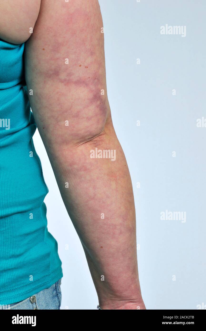 Not for use in Television Not for use in Television Back of the arm in ...