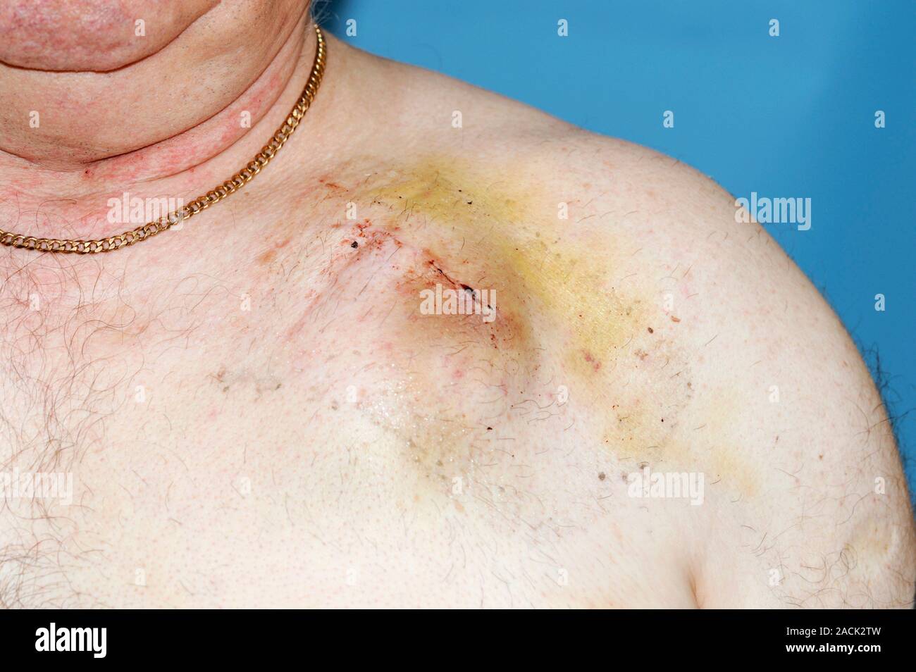 Not for use in Television Not for use in Television Pacemaker inserted ...