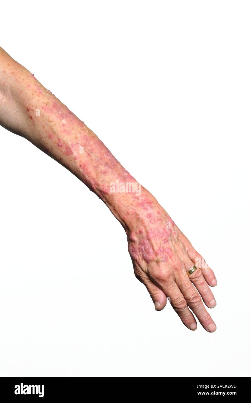 Not for use in Television Not for use in Television Rash on the lower ...