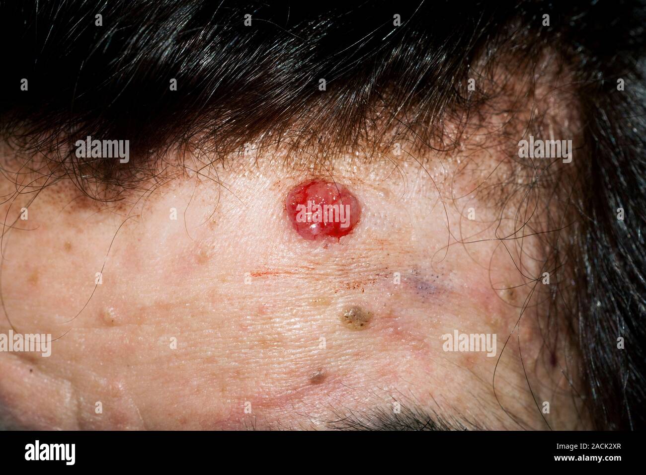 Close Up Of Skin Cancer Basal Cell Carcinoma On The Forehead In A 75 Year Old Female Patient