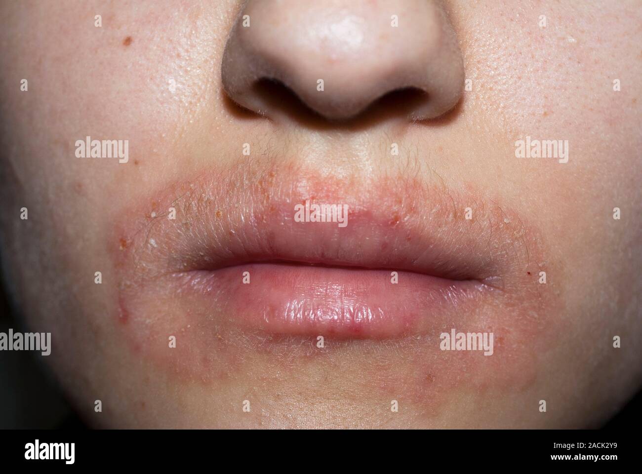 Close-up of dermatitis around the mouth in a teenage girl caused by a ...