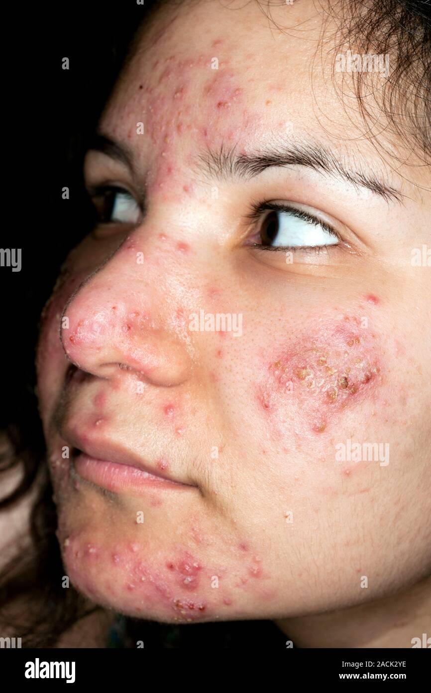 Acne vulgaris (pimples) on the skin of the face in a teenage girl. Acne ...