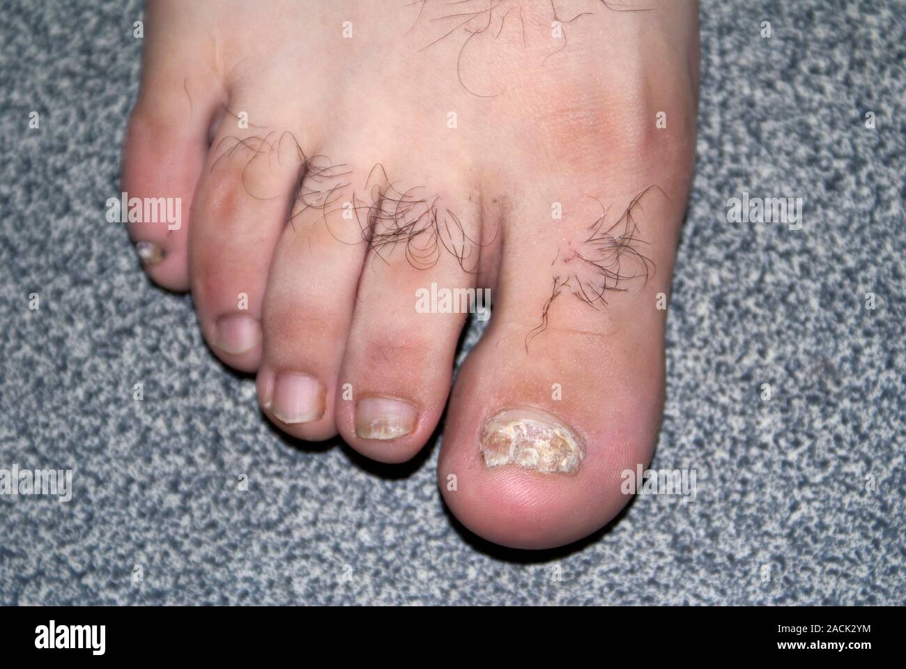 Close-up of the foot showing a fungal infection of the toenails in a ...